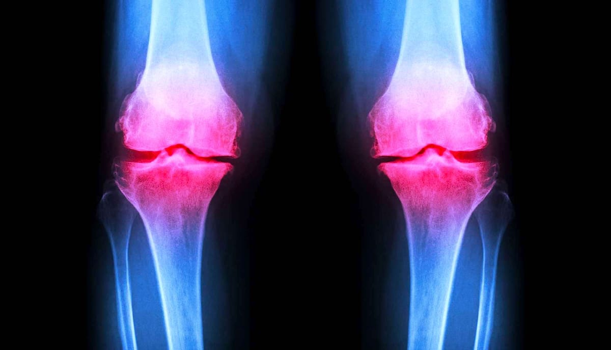 Un hydrogel injectable pour régénérer le cartilage endommagé des ...